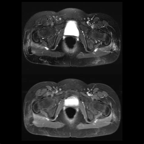 Pediatric Dermatomyositis Pediatric Radiology Reference Article