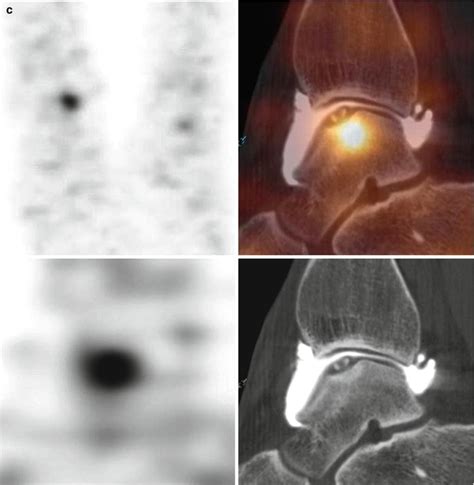 Diagnosis Of Osteochondral Defects Of The Talus By Computerized