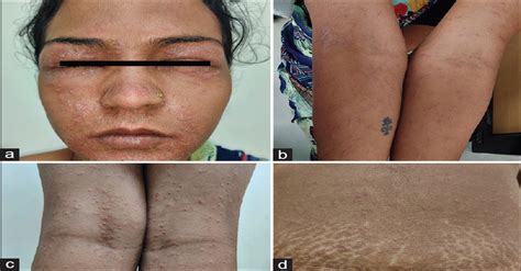 Systemic Allergic Contact Dermatitis Post Inactivated Covid