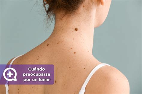 Cuando Preocuparse Por Un Lunar Nevus Melanocítico Mediquo