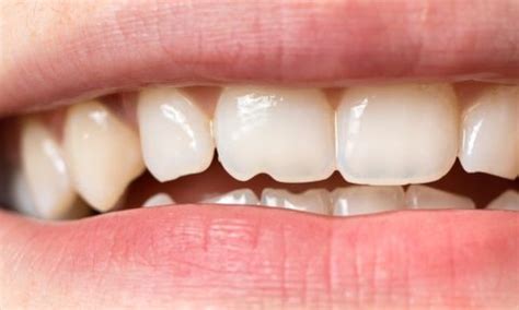 Sharp Tooth How To Fix It