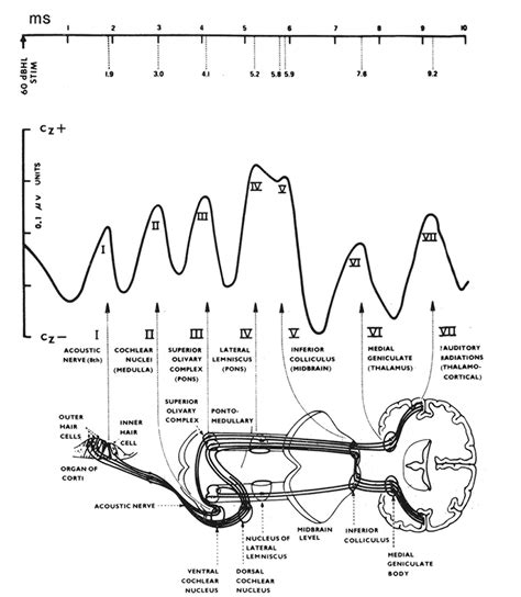 Detection And Localization Of Occult Lesions With Brainstem Auditory
