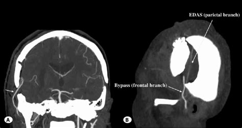 A Postoperative Coronal Ct Angiogram Confirms Patency Of Bypass With Download Scientific A Postoperative Coronal Ct Angiogram Confirms Patency Of Bypass With Download Scientific