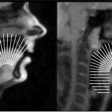 Semi Polar Grid Lines For The Estimation Of Vocal Tract Aperture