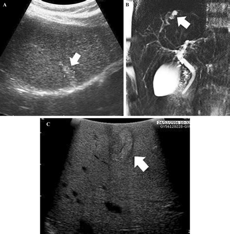 A 58 Year Old Female Patient Who Has Hepatic Wedge Lesion With