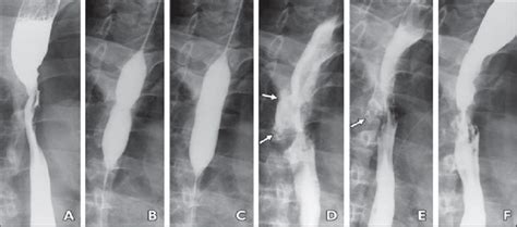 Esophageal Cancer X Ray