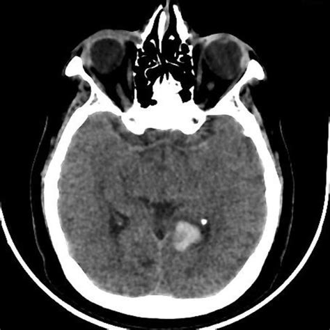 Head Ct Scan Showing Spontaneous Hyperdensity In Favour Of An Download Scientific Diagram
