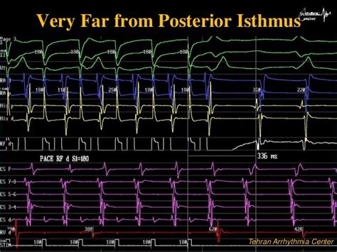 Ablation Of Atypical Flutter