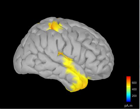 Eeg Improving Source Localization Discussions Brainstorm