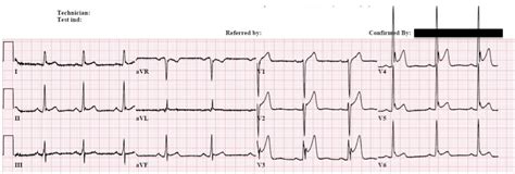 Dr Smith S ECG Blog Best Explanation Of Terminal QRS Distortion In Diagnosis Of