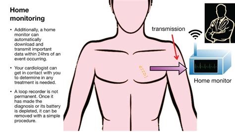 Loop Recorder Implantation Bayside Heart