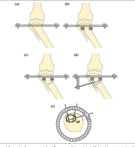 Figure 1 From Gradual Correction Of Proximal Tibia Deformity For Blount Disease In Adolescent