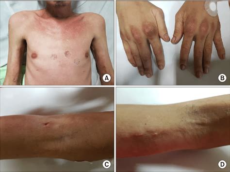 A Multiple Erythematous Patches On The Anterior Neck And Upper Chest Download Scientific