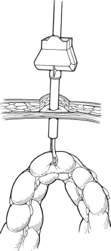 Loop Colostomy And Colostomy Closure Basicmedical Key