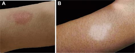 Contact Leukoderma Following Allergic Contact Dermatitis To A Smartwatch A Consequence Of