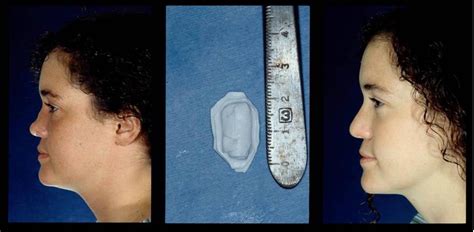 Saddle Nose Deformity Rhinoplasty Archive