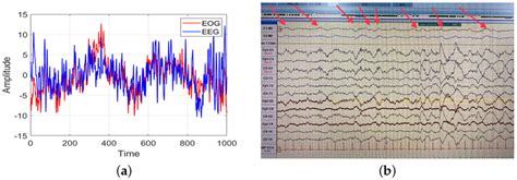Comparison Of Eog Signal And Prefrontal Eeg Signal A Comparison Of