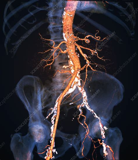 Atherosclerosis And Aortofemoral Bypass Ct Scan Stock Image C057 9283 Science Photo Library