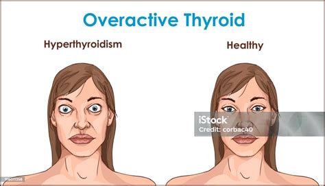 Hypothyroidism Face Before And After