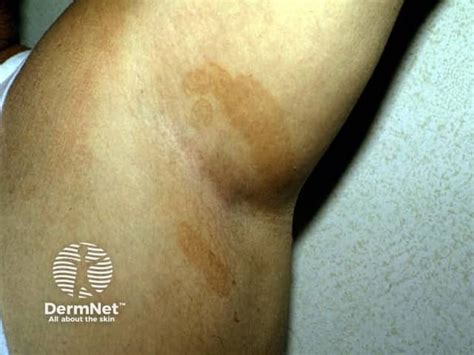 Candidal Intertrigo Armpit