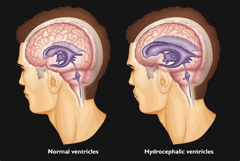 Hydrocephalus Longhorn Brain And Spine