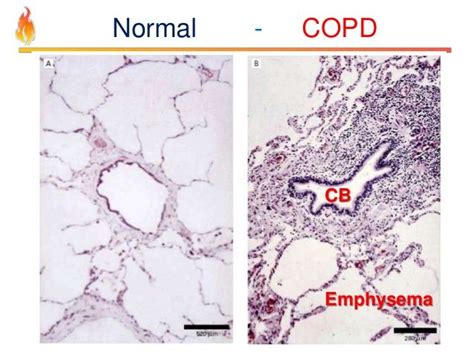 Copd Histology
