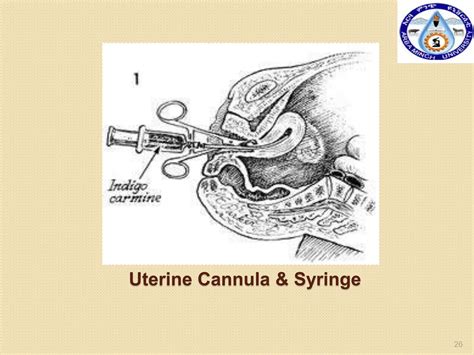 Special Radiographic Procedure Hysterosalpingographypptx
