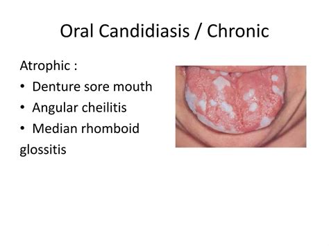 Oral Mucosal Ulceration Pptx