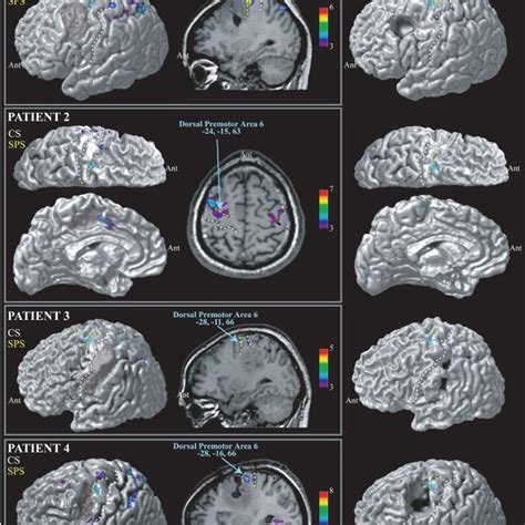 Overview Of The Neuronavigation System Used During Neurosurgery A