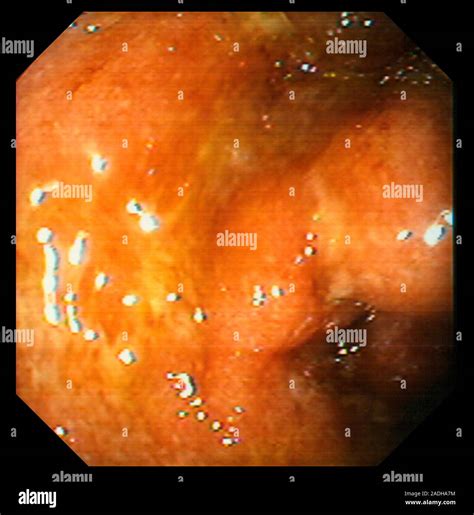 Ulcerative Colitis Endoscope View Showing A Colon Large Intestine Affected By Ulcerative