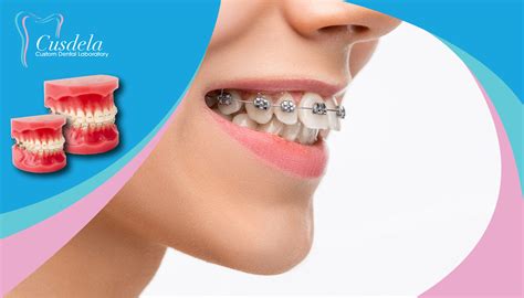 How Can Braces Fix An Overbite Issue Blog