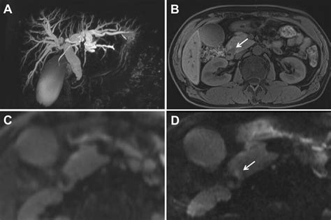 A 49 Year Old Man With Distal Common Bile Duct Cbd Carcinoma With A Download Scientific