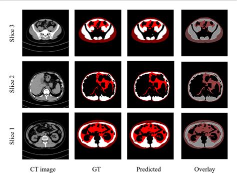 Figure 2 From Detection Of Sarcopenia Using Deep Learning Based