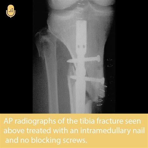 Orthobullets Proximal Tibial Metaphyseal Fractures Being Facebook