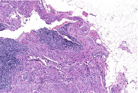 Pathology Outlines Lymphangiomyomatosis