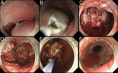 The Key Steps Of Eftr A Endoscopic View Of E Gist B Submucosal