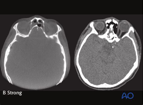Cone Beam Vs Fan Beam Ct