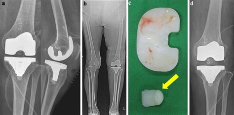 A Case 2 A 63 Year Old Female Underwent Left Total Knee Arthroplasty Download Scientific