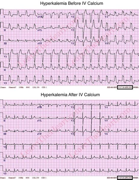 Hyperkalemia Ecg Review Criteria And Examples