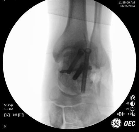 Calcaneus Fracture Discussion I Would Love To Hear Thoughts On Orif Vs Orif Primary Subtalar