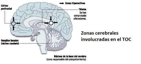 Neuroimagen En El Trastorno Obsesivo Compulsivo Consulta Iglesias