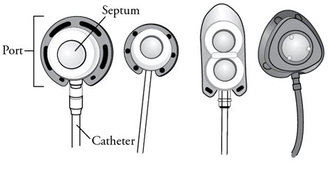 Caring For Your Implanted Port For Pediatric Patients Memorial Sloan Kettering Cancer Center