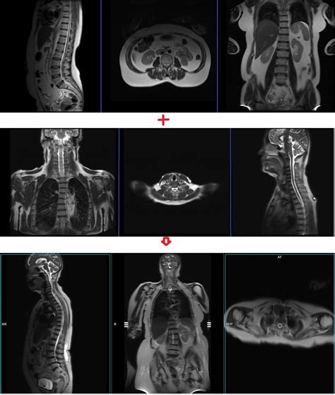 Mri Full Spine Mri Whole Spine Automatic Composing Protocol And Planning
