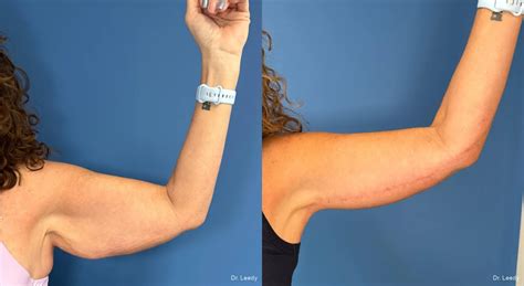 Brachioplasty Before And After Gallery Patient 14