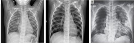 Cxr Images With Differece Class A Normal B Viral Pneumonia And