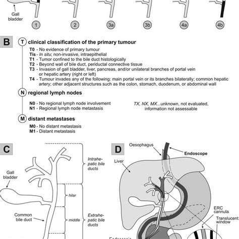 Anatomy Bismuthtnm Classification And Pdt For Hilar Download Anatomy Bismuthtnm Classification And Pdt For Hilar Download
