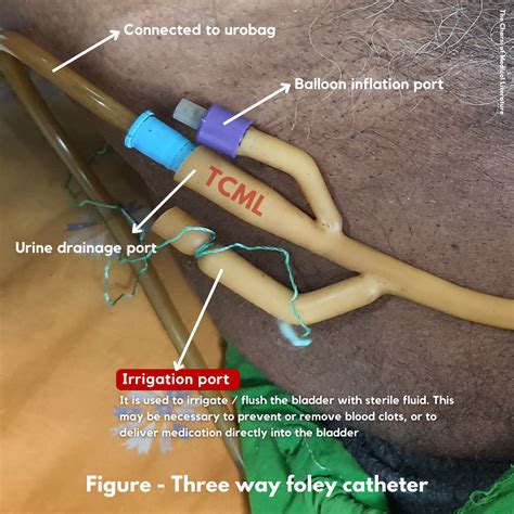 3 Way And 2 Way Foley Catheter Tcml Flux