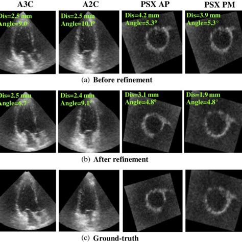 Examples Of Standard Plane Extraction Average Case A Before
