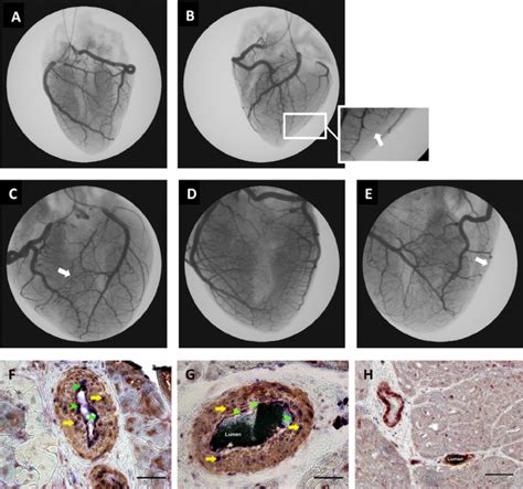 A And B Postmortem Angiograms After Acute Lcx Occlusion Showed Rapid Download Scientific