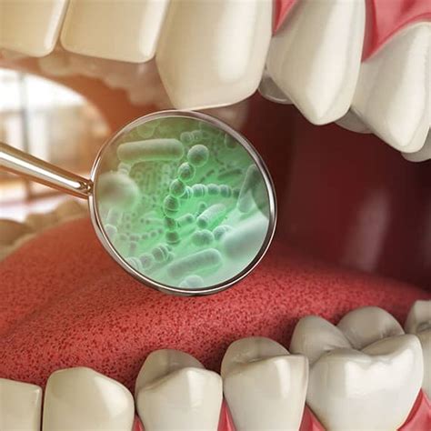 Periodontal Disease Treatment In Vancouver Periodontal Disease